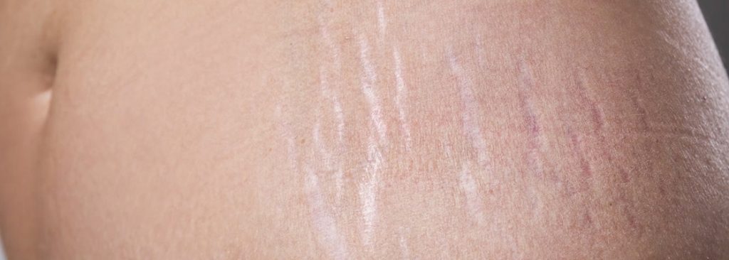 Stretch Mark Removal & Stretch Marks Treatment Sydney