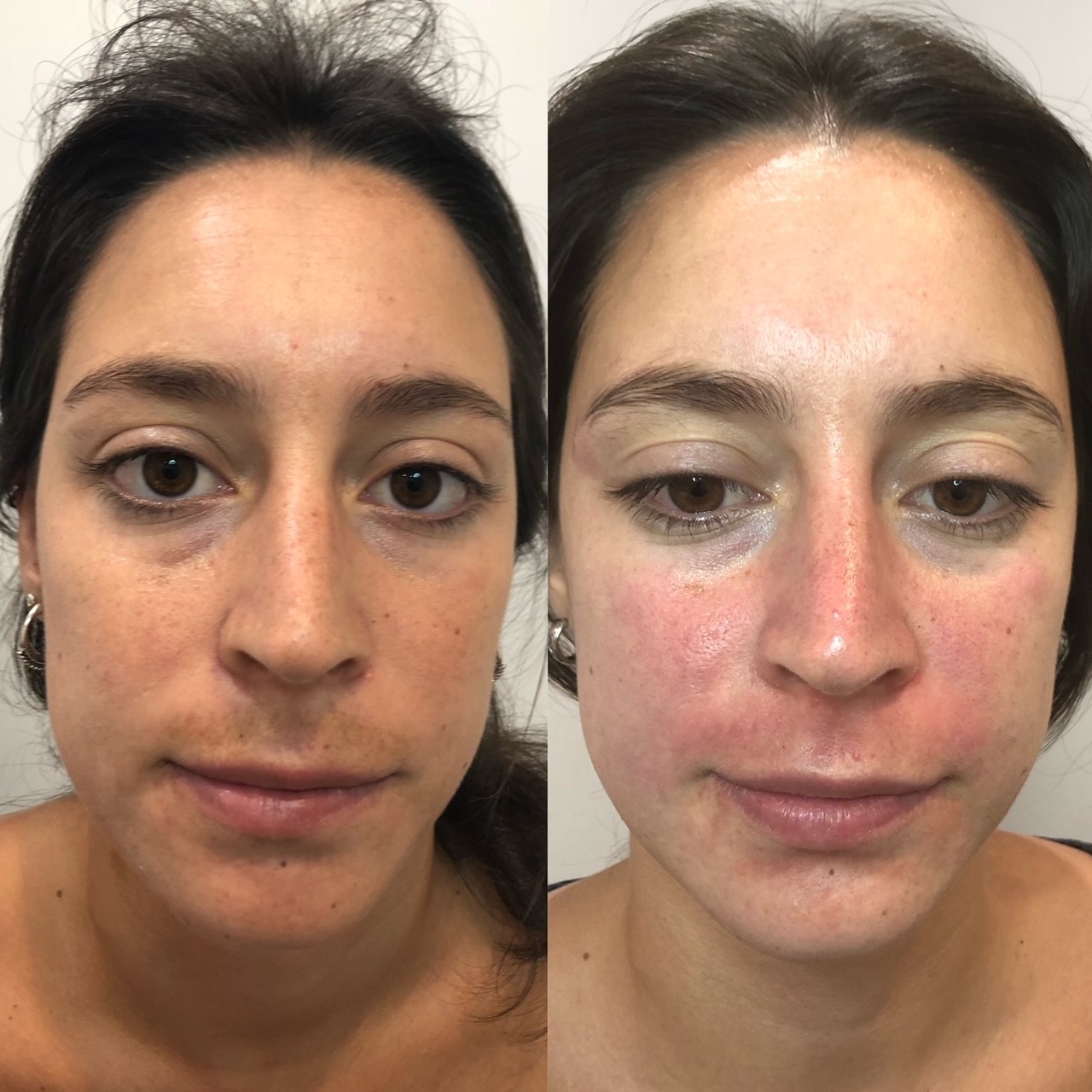 Cosmelan Depigmentation Treatment - Skinnovation Laser Clinic