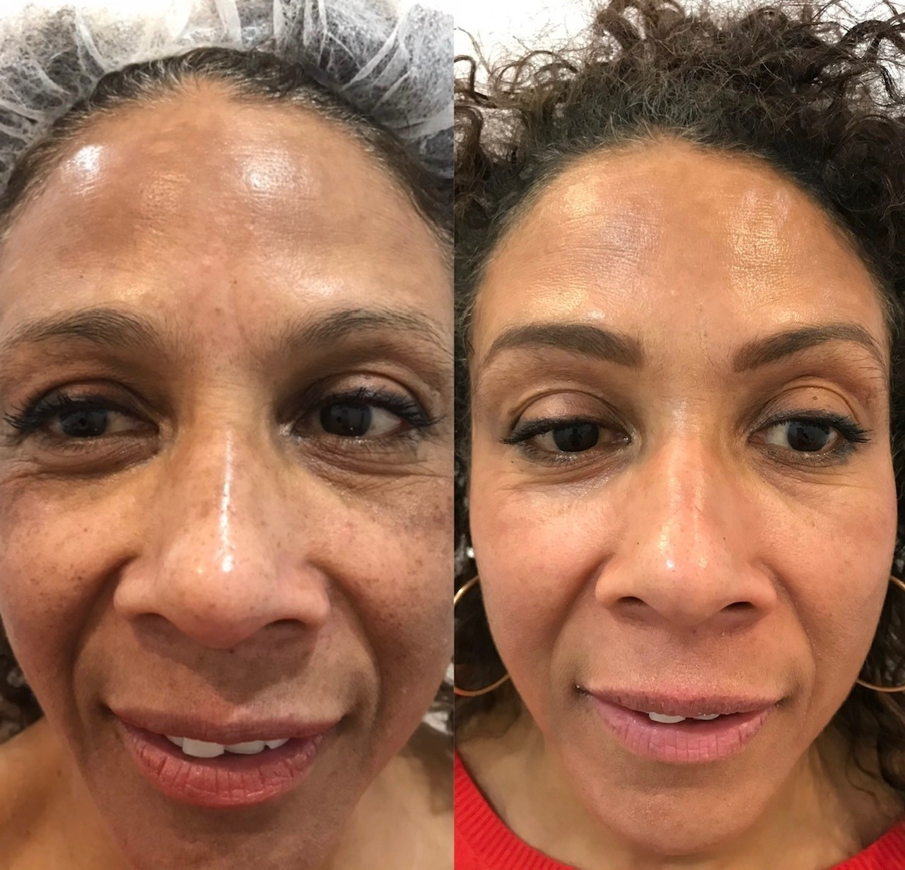 Cosmelan Depigmentation Treatment - Skinnovation Laser Clinic